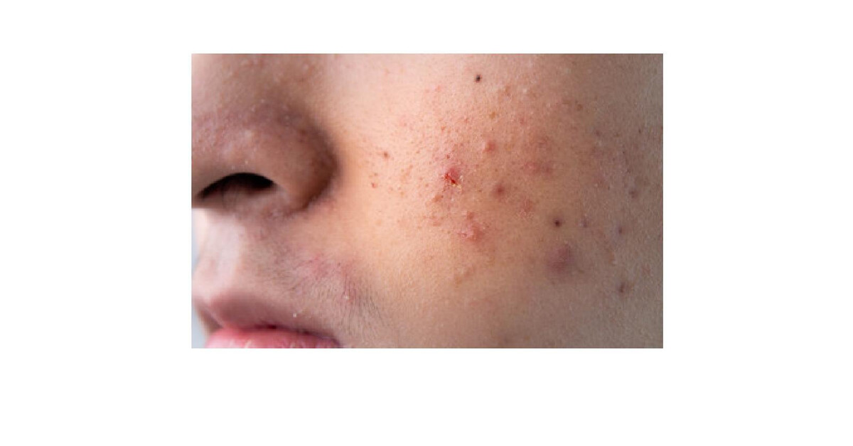 Spots, spots and more spots